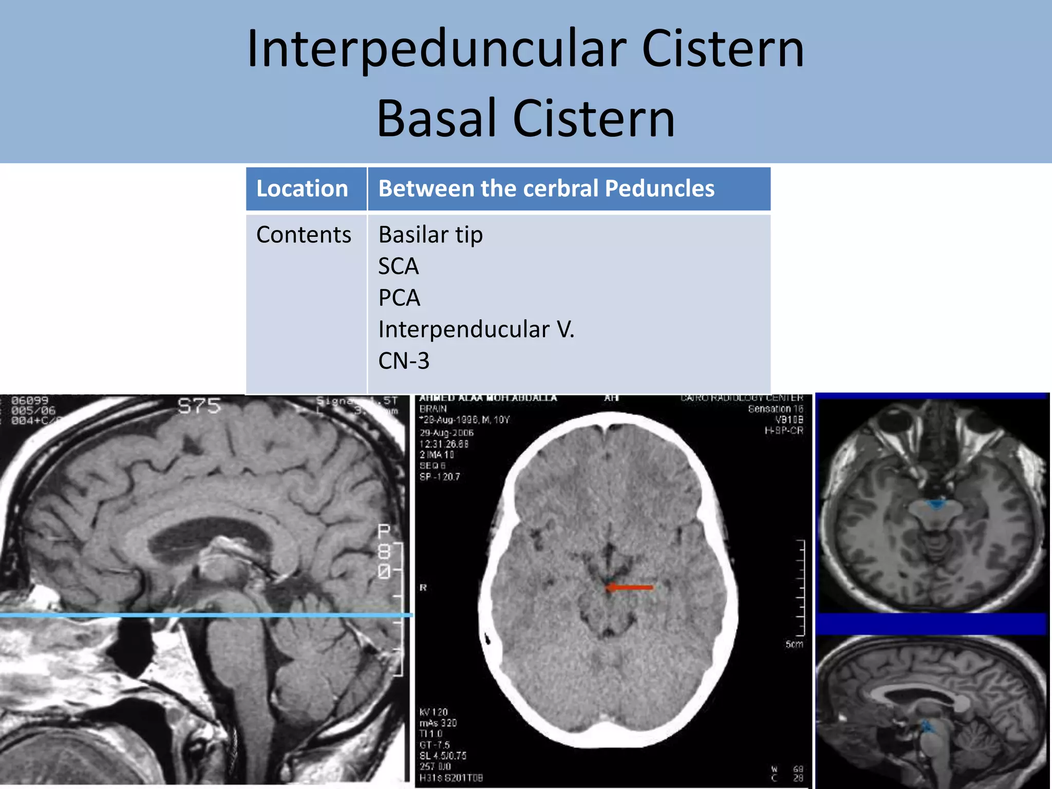 Cisterns of brain and its contents along with its classification and ...