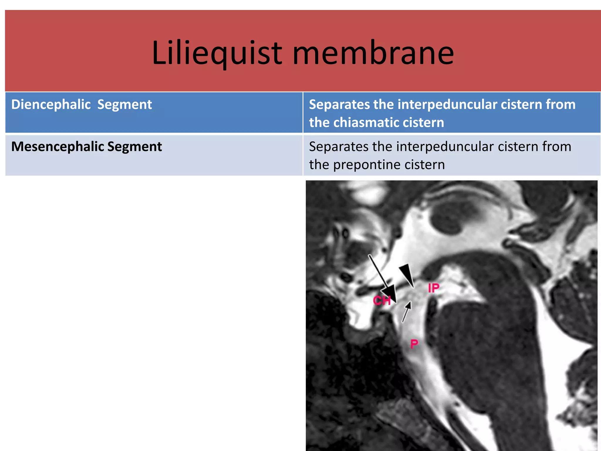 Cisterns of brain and its contents along with its classification and ...