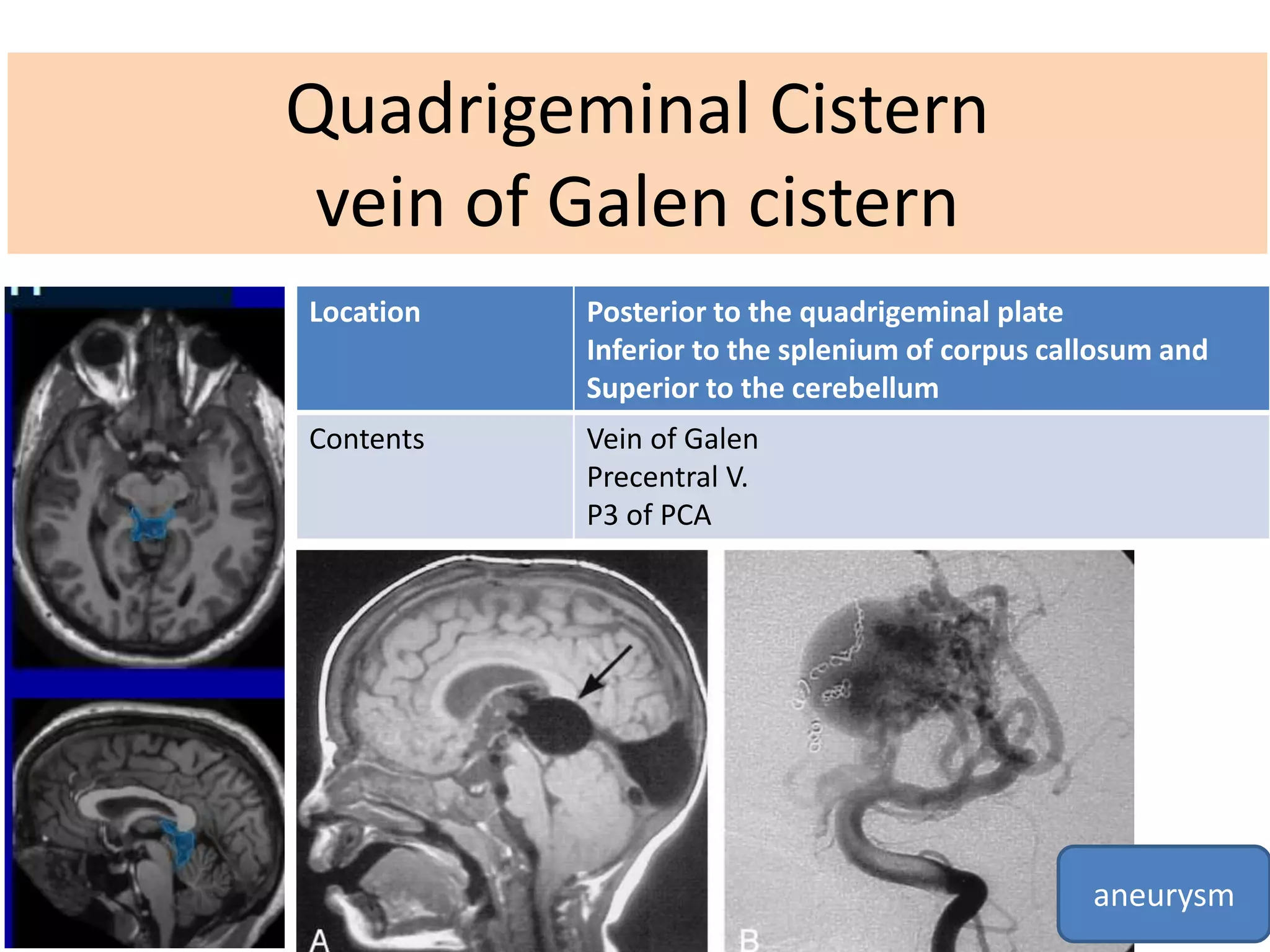 Cisterns of brain and its contents along with its classification and ...