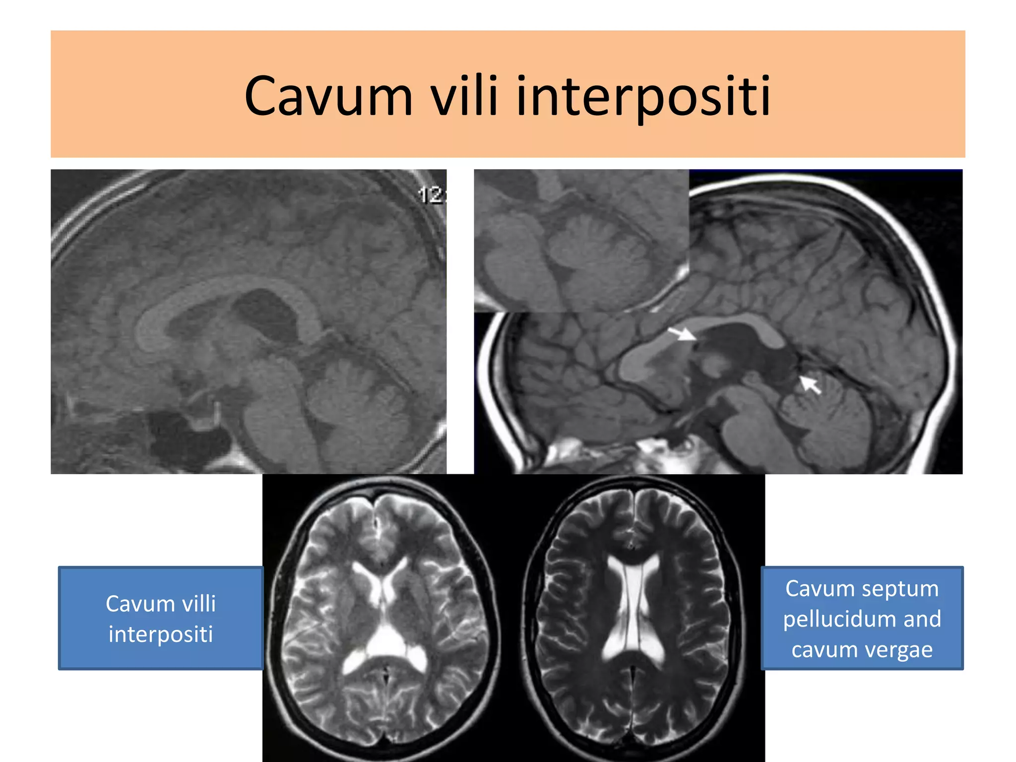 Cisterns of brain and its contents along with its classification and ...