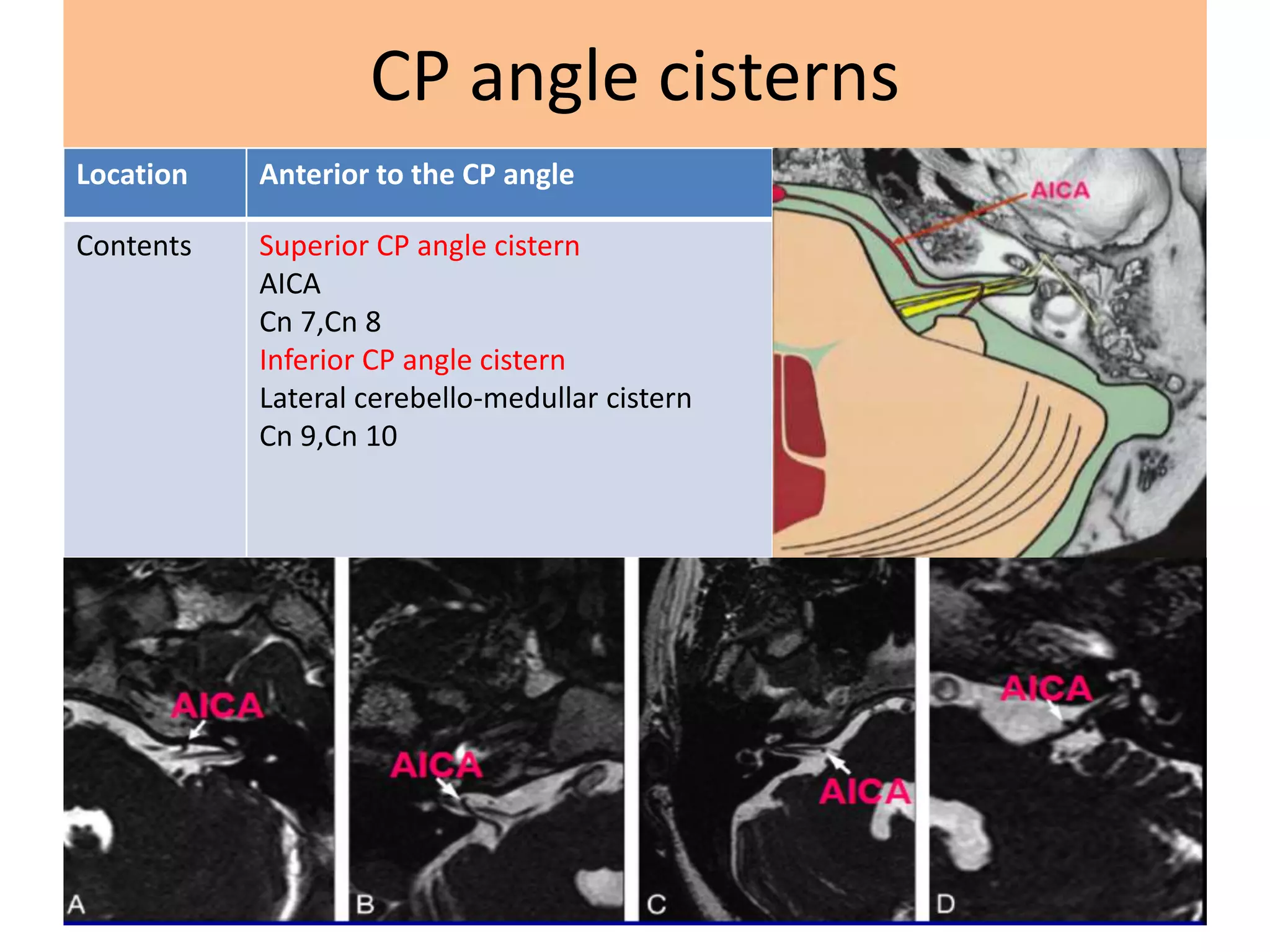 Cisterns of brain and its contents along with its classification and ...