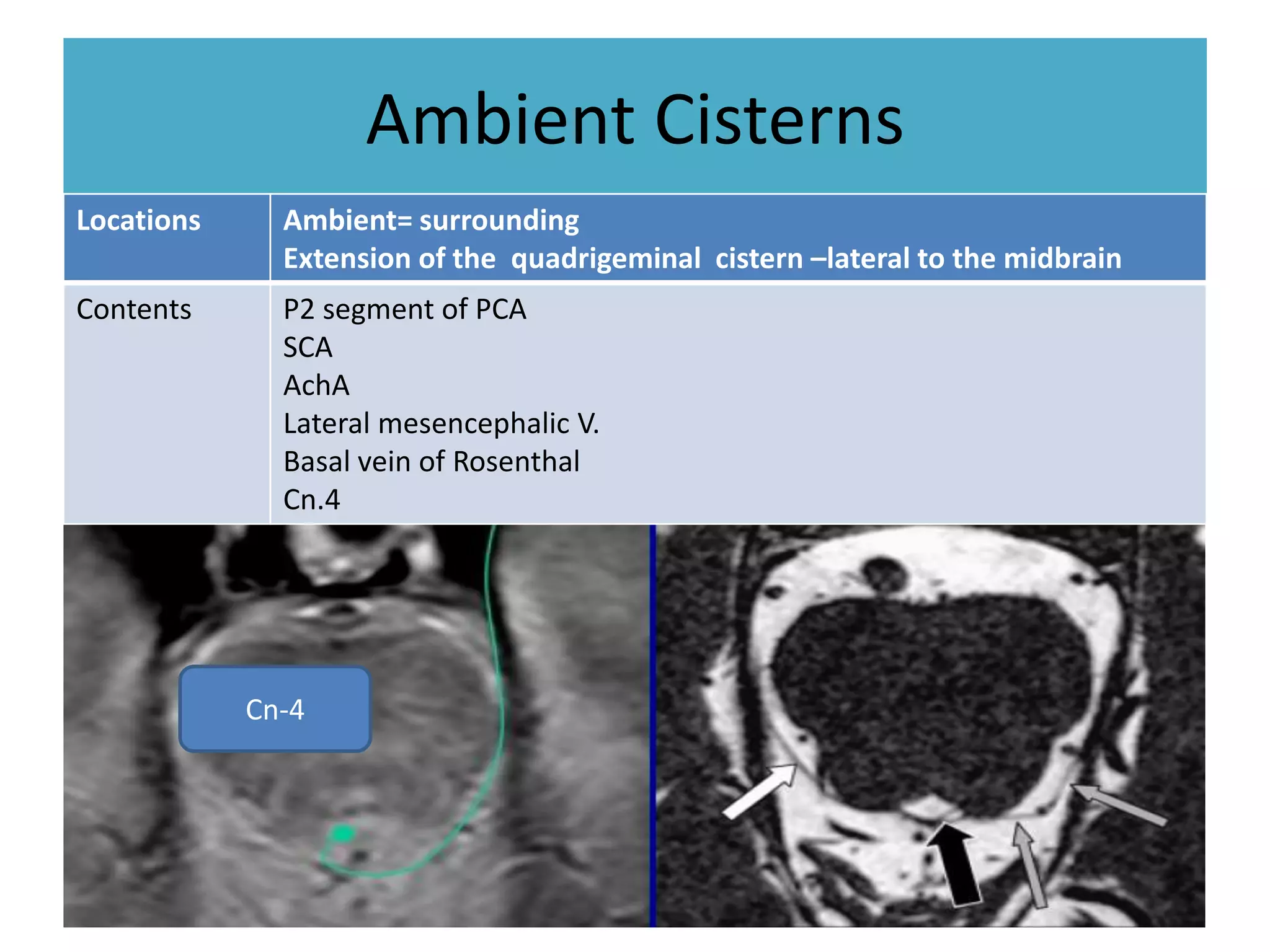 Cisterns of brain and its contents along with its classification and ...