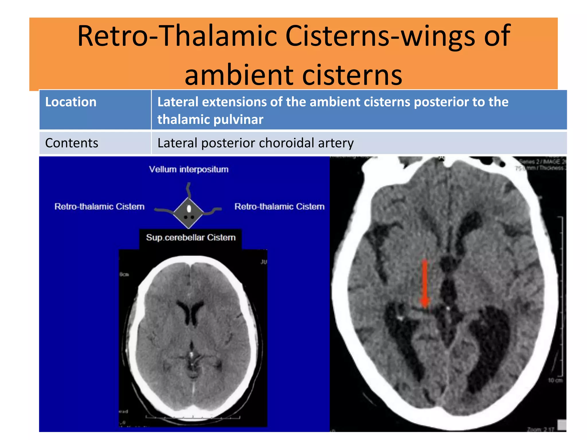 Cisterns of brain and its contents along with its classification and ...