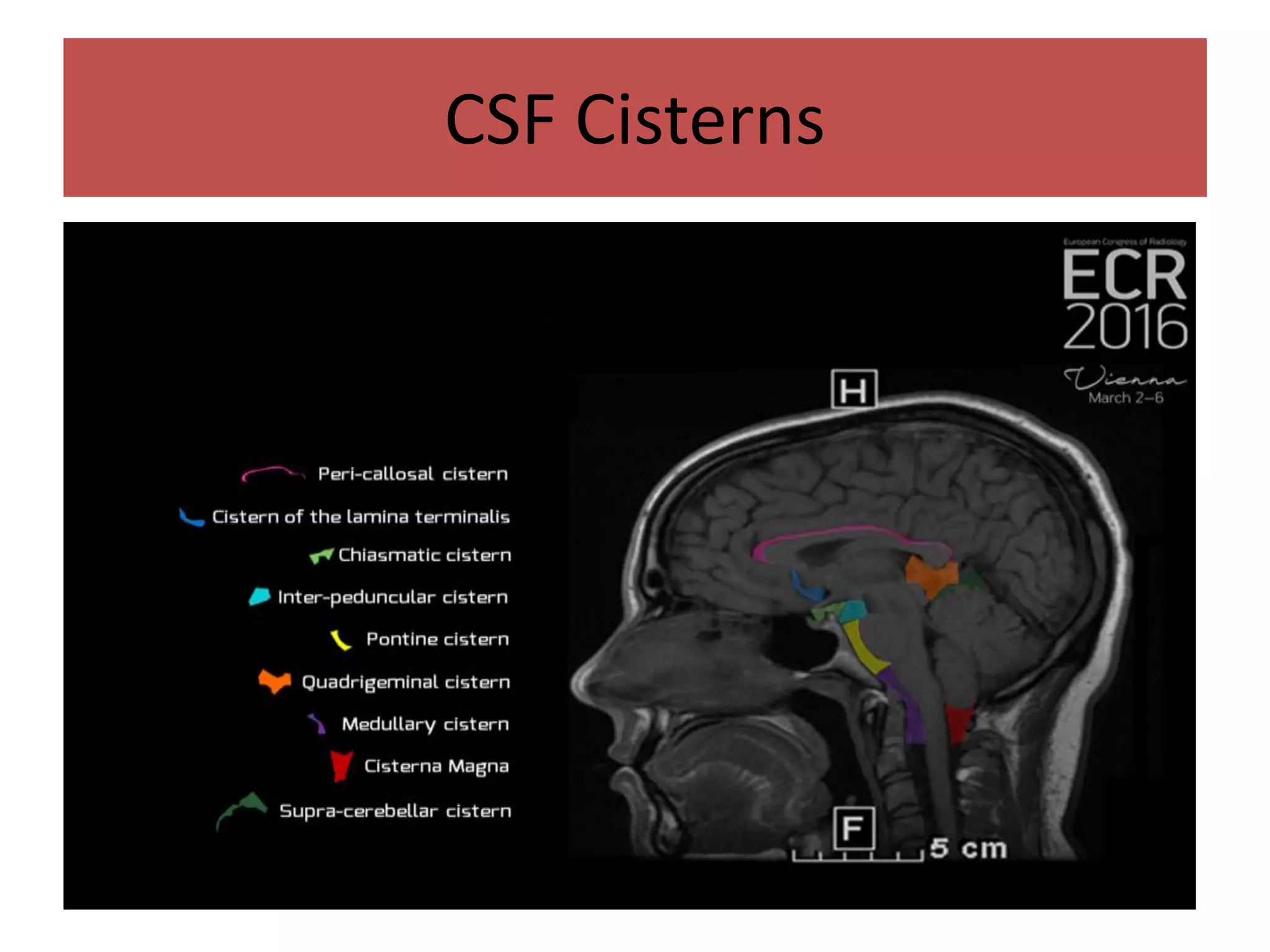 Cisterns of brain and its contents along with its classification and ...