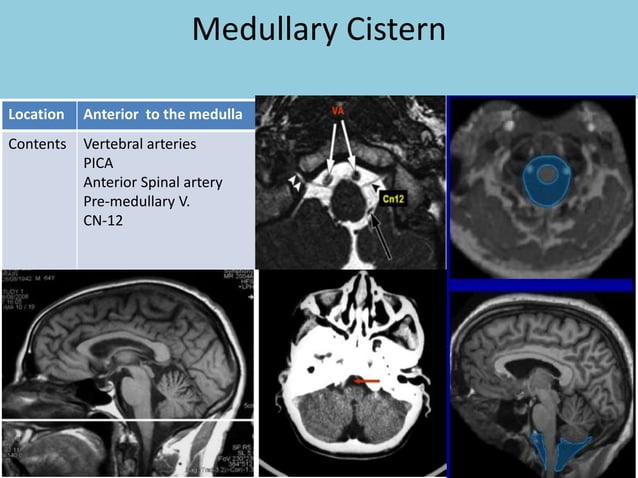 Cisterns of brain and its contents along with its classification and ...