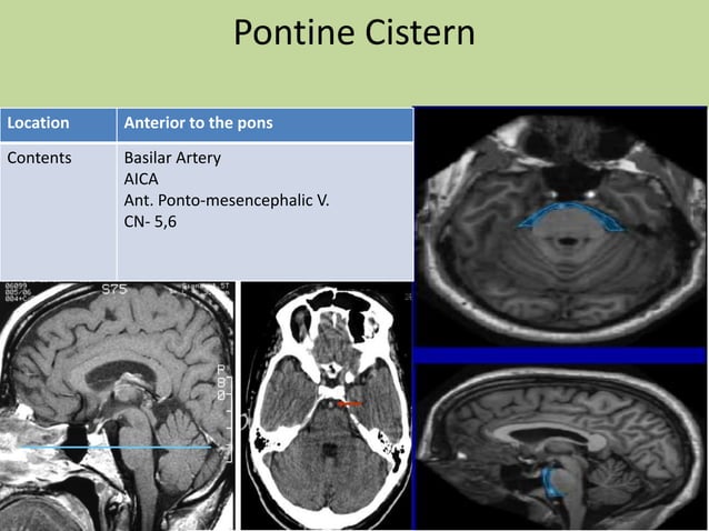 Cisterns of brain and its contents along with its classification and ...