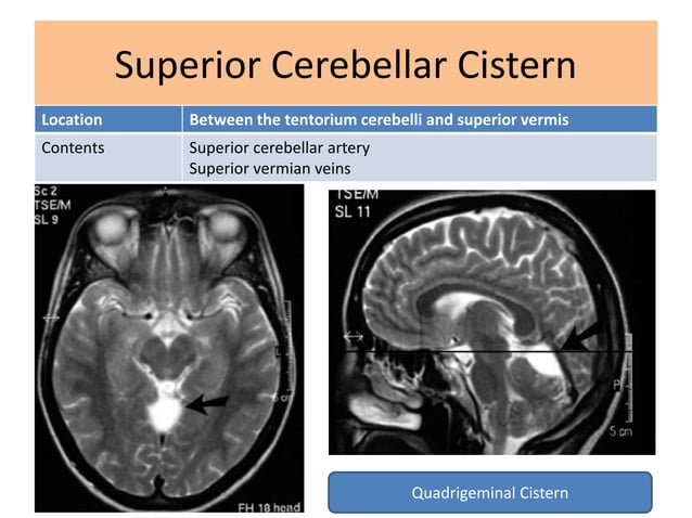 Cisterns of brain and its contents along with its classification and ...