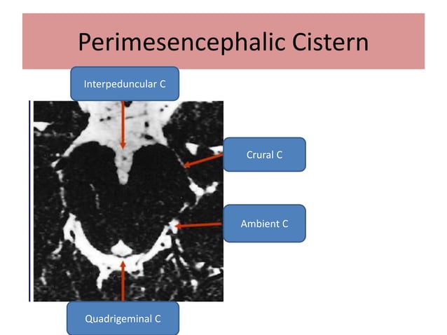 Cisterns of brain and its contents along with its classification and ...