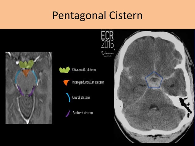 Cisterns of brain and its contents along with its classification and ...