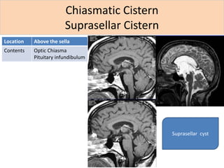 Cisternae Pronunciation
