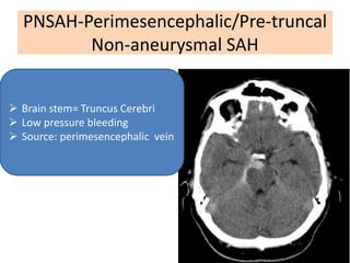 Perimesencephalic Cistern