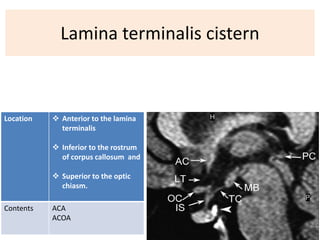 Lamina Terminalis Cistern