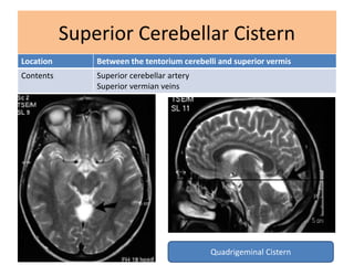 Cisterns of brain and its contents along with its classification and ...