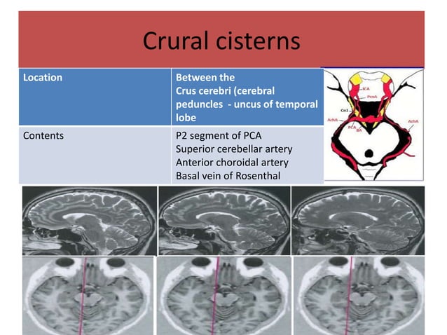 Cisterns of brain and its contents along with its classification and ...