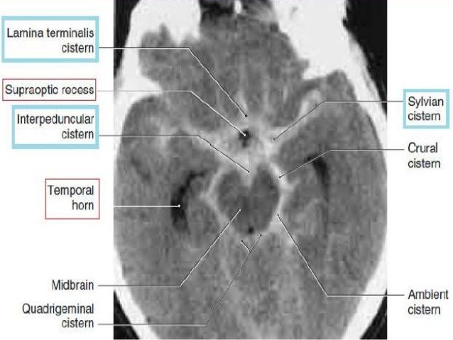 Cisterns of brain and its contents along with its classification and