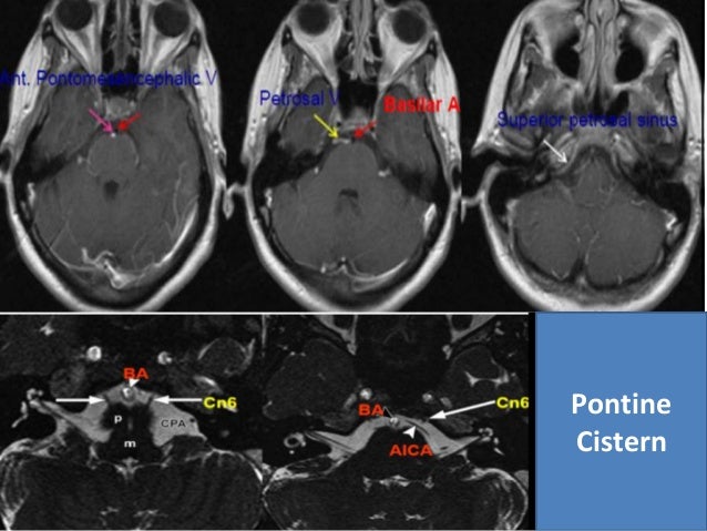 Cisterns of brain and its contents along with its classification and