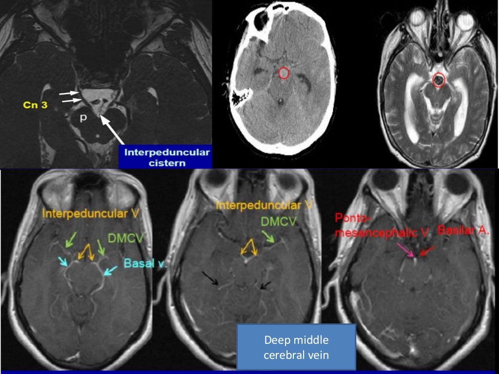 Cisterns of brain and its contents along with its classification and
