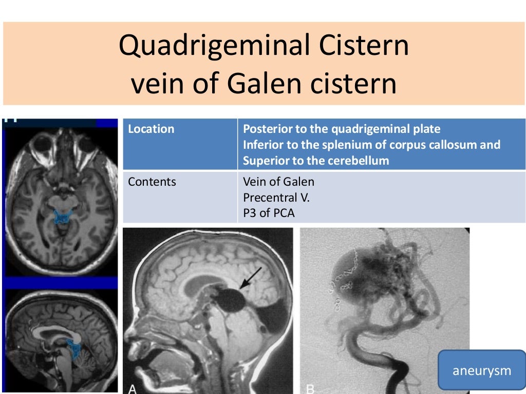 Cisterns of brain and its contents along with its classification and