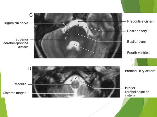 SUB ARACHNOID CISTERNS &VENTRICLES OF BRAIN | PPTX