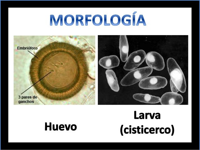 Cisticercosis