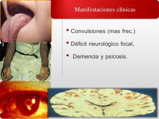 Cisticercosis