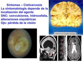 Cisticercosis | PPTX