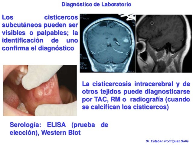 Cisticercosis