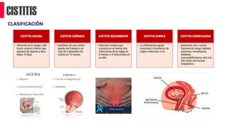 CISTITIS.pdf