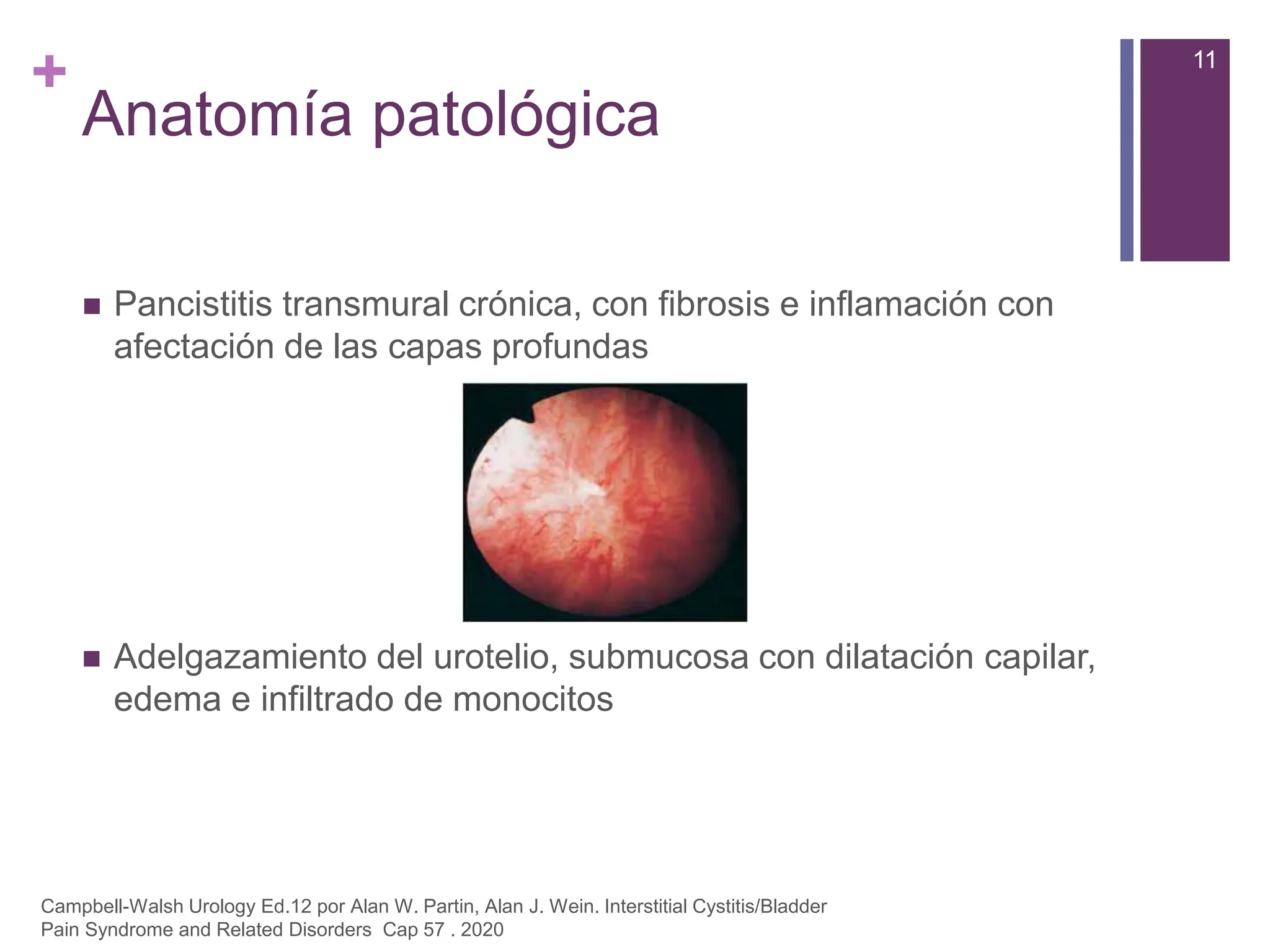 Cistitis intersticial síndrome de vejiga dolorosa | PPTX