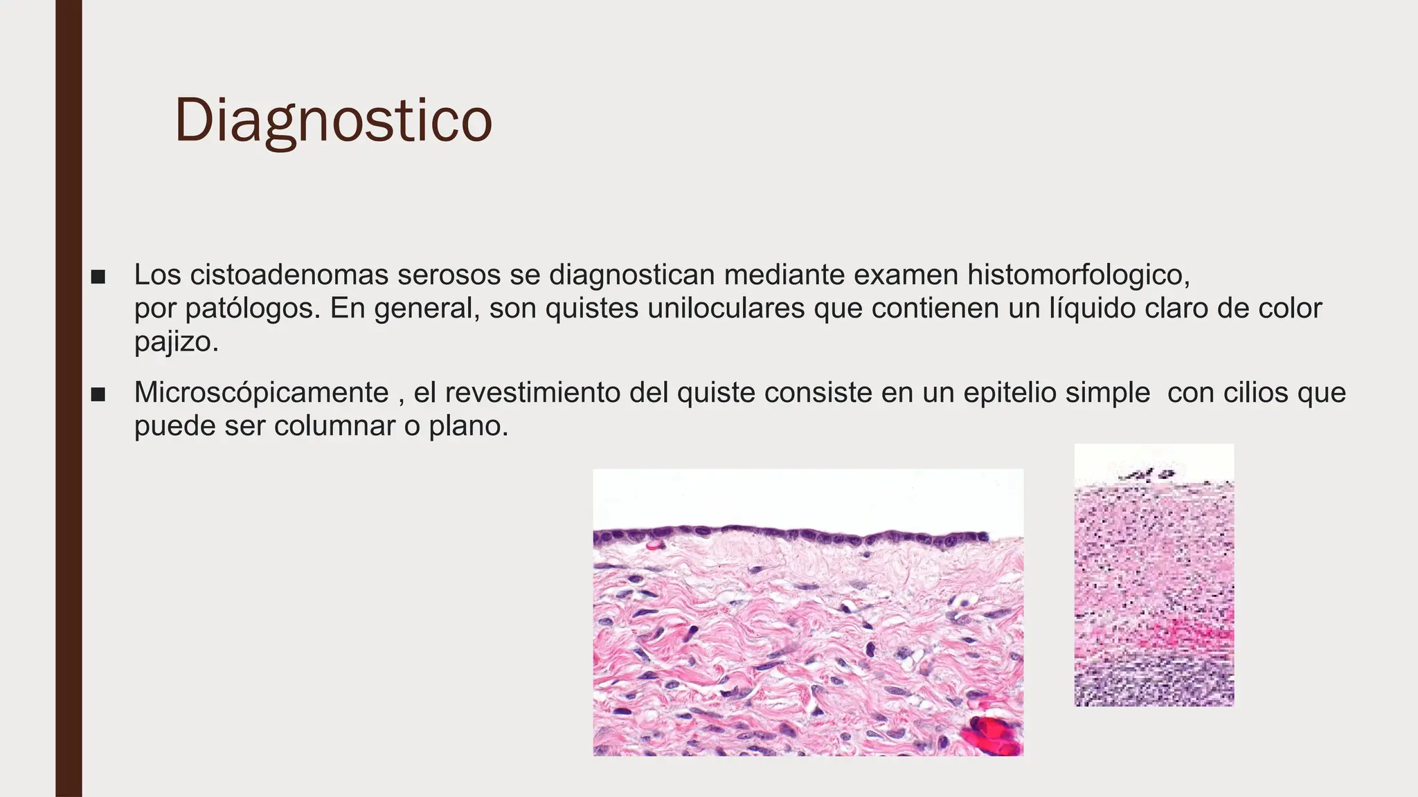 cistoadenoma serosodiagnostico y caracteristicas.pptx