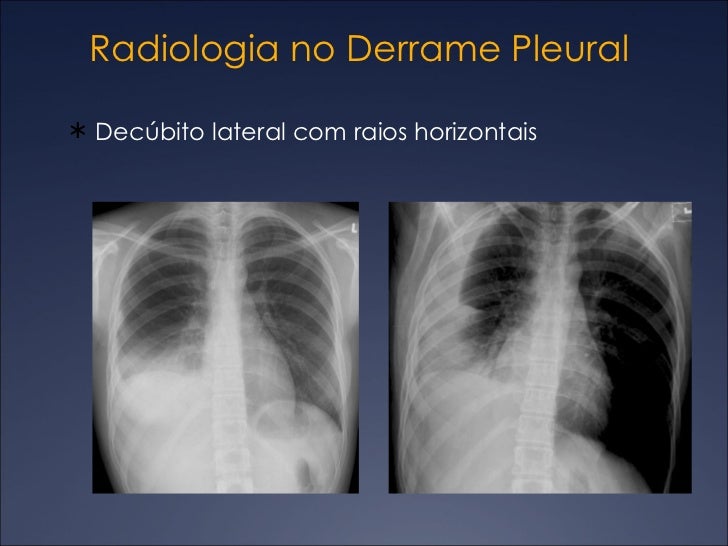 Cistos e cavidades pulmonares