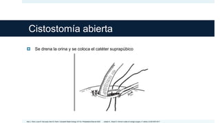 Cistostomía ....pptx