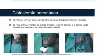 Cistostomía ....pptx