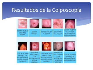 Aspectos útiles De La Colposcopia Digital, 51% OFF