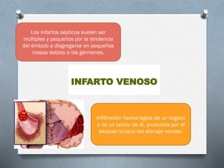 TIPOS DE INFARTO | PPTX