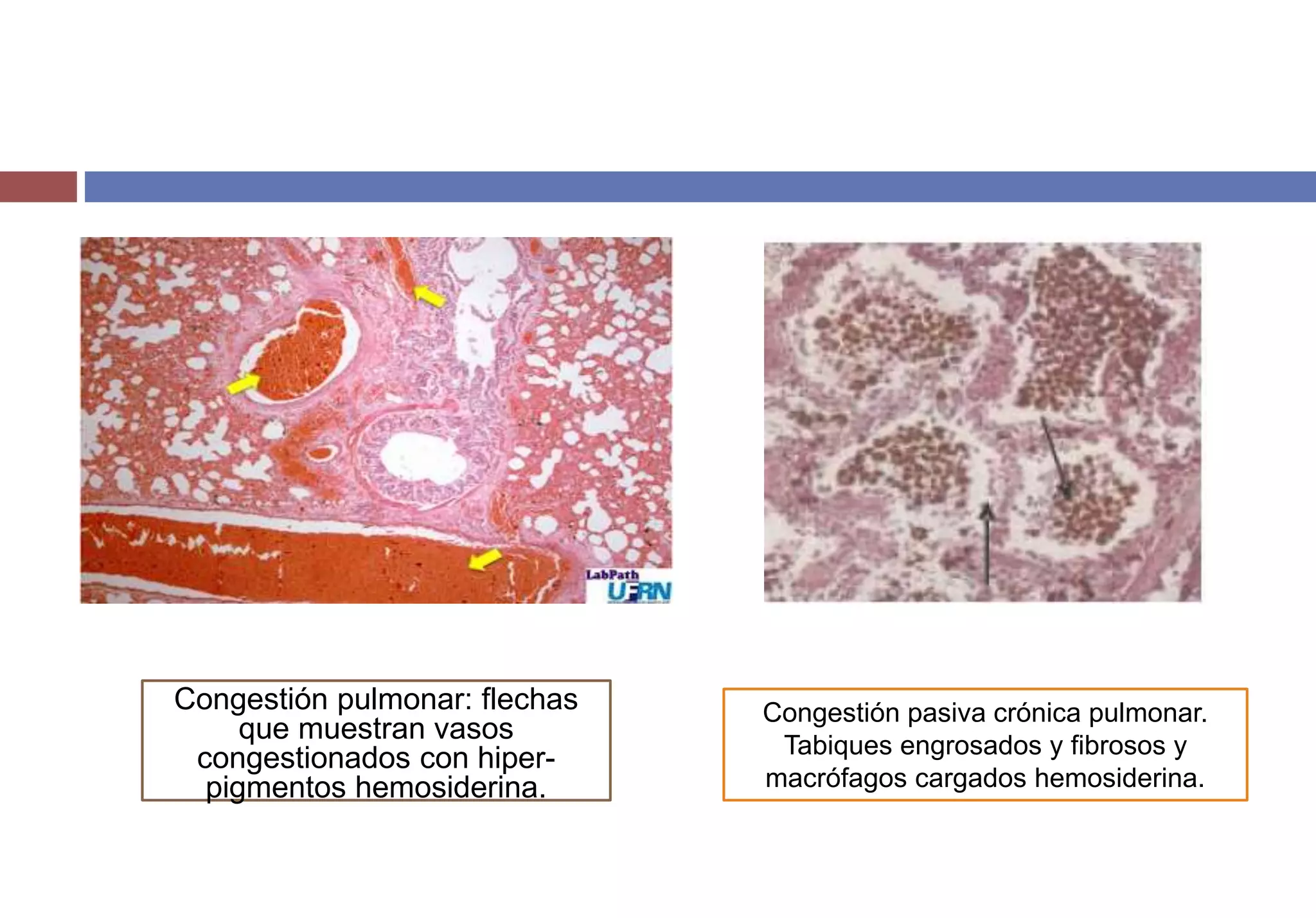 HIPEREMIA Y CONGESTIÓN TRANSTORNOS HEMODINAMICOS | PPTX
