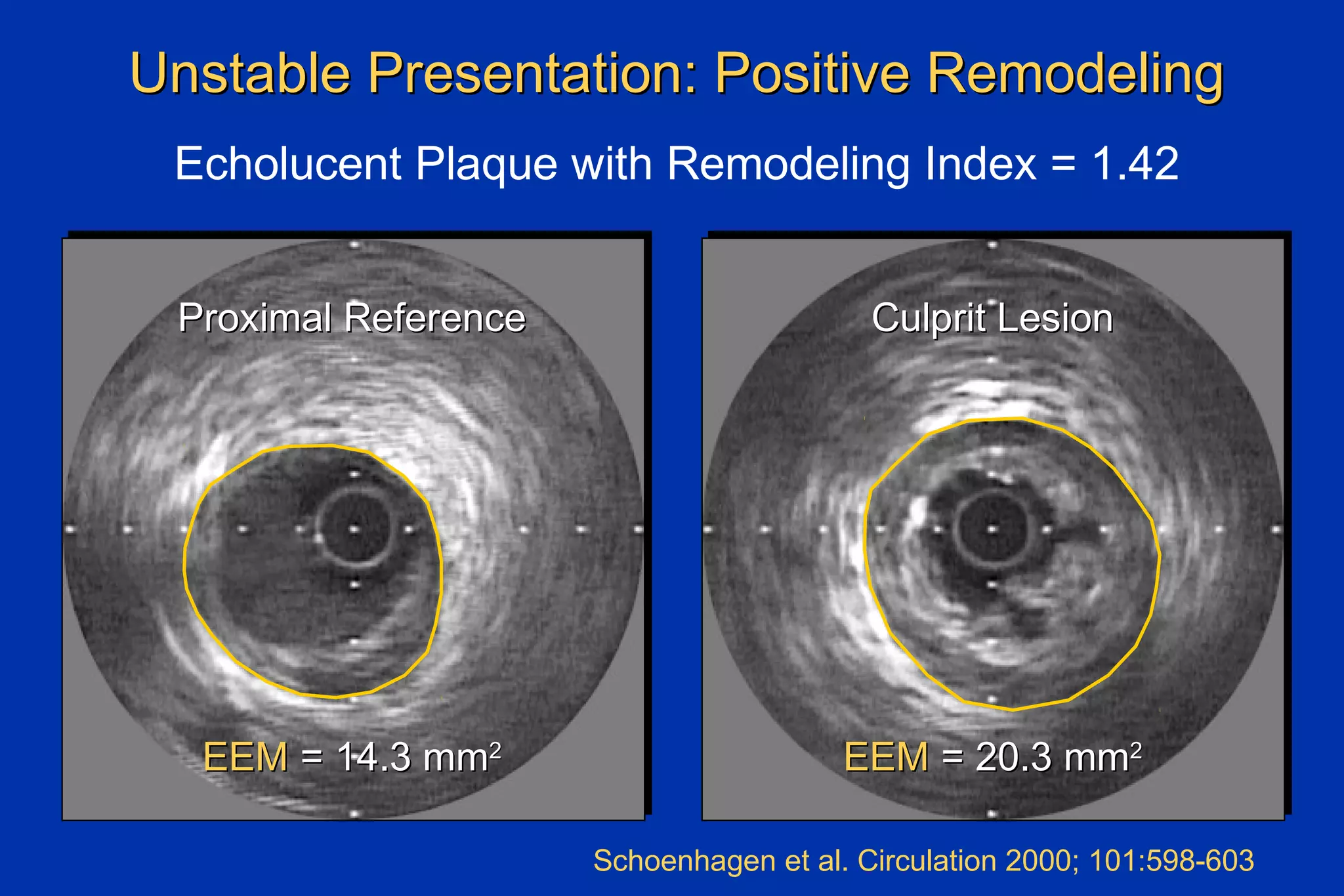 Arterial remodeling in st vs unst cs | PPT | Heart and Cardiovascular ...