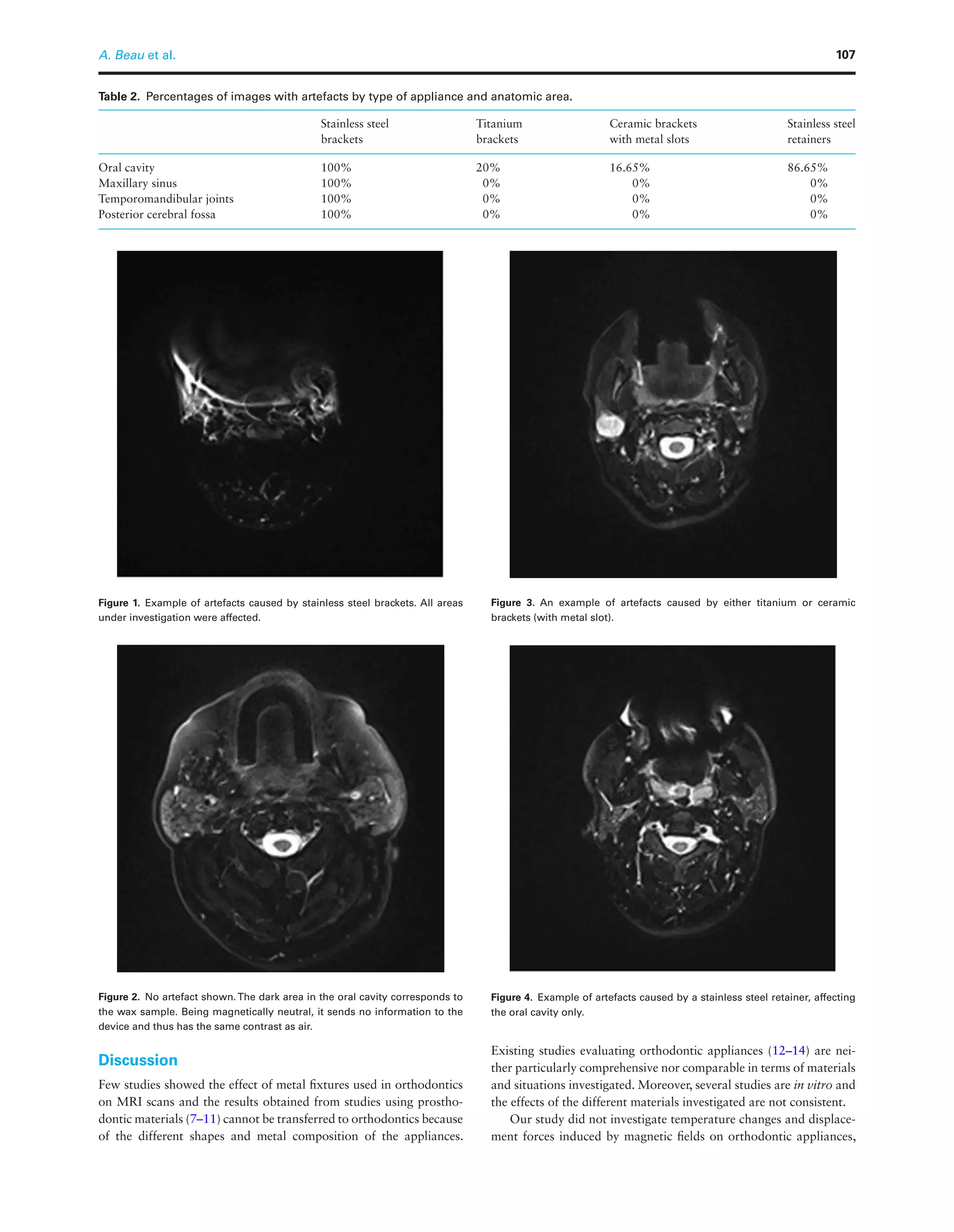 Magnetic resonance imaging artifacts and fixed orthodontic attachments | PDF