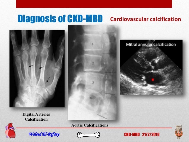 Chronic Kidney Disease-Mineral Bone Disease