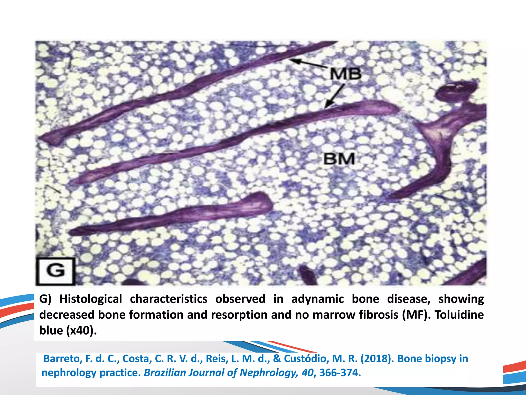 CKD MBD; make it easy | PPTX