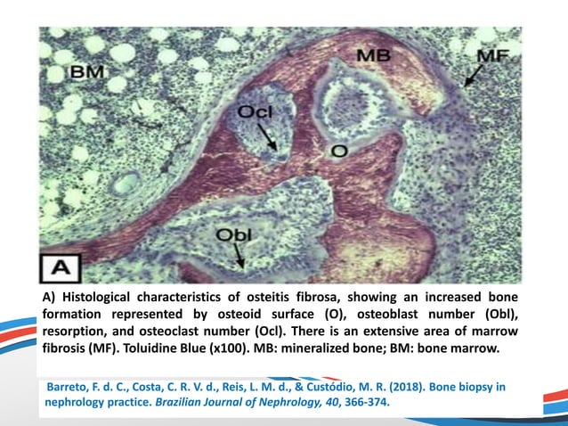 CKD MBD; make it easy | PPTX | Endocrine and Metabolic Diseases ...