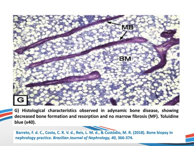 CKD MBD; make it easy | PPTX | Endocrine and Metabolic Diseases ...