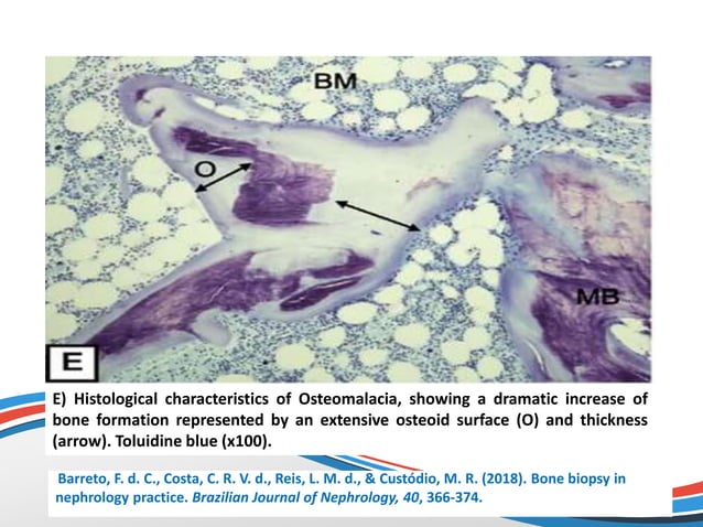 CKD MBD; make it easy | PPTX | Endocrine and Metabolic Diseases ...