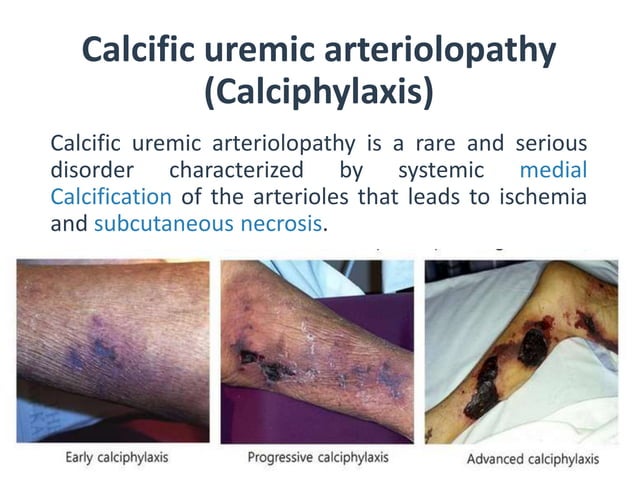 CKD MBD; make it easy | PPTX | Endocrine and Metabolic Diseases ...