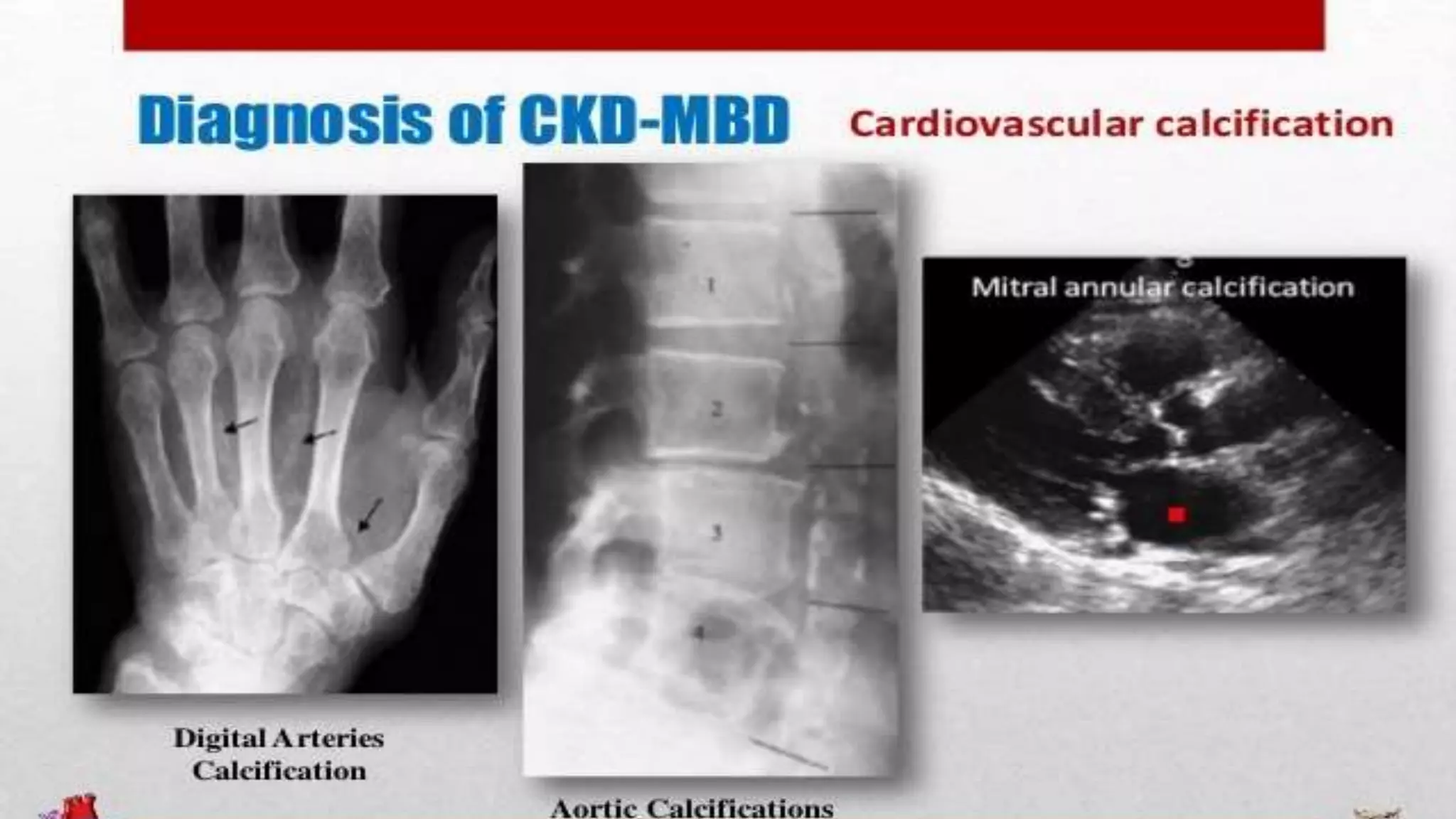 CKD - MBD MODIFIED.pptx