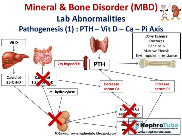 CKD MBD chronic kidney disease mineral bone disease Dr. Abdel Rahman Mansy