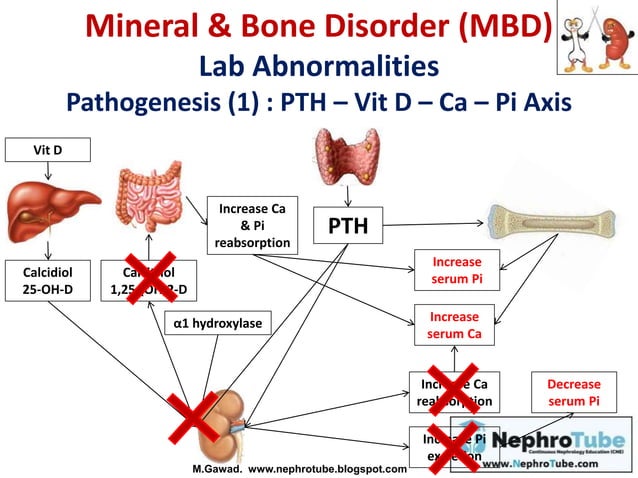 CKD Mineral Bone Disorder (CKD-MBD) - Dr. Gawad | PPTX