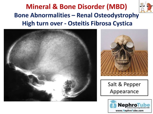 CKD Mineral Bone Disorder (CKD-MBD) - Dr. Gawad | PPTX