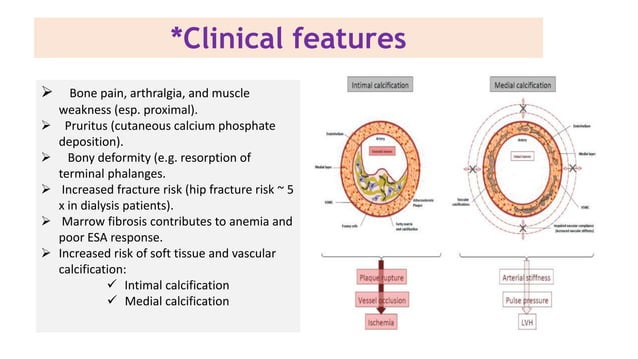 Chronic kidney disease mbd full version.pptx