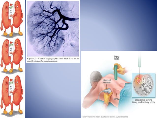 Chronic kidney disease ppt presentation for class | PPT